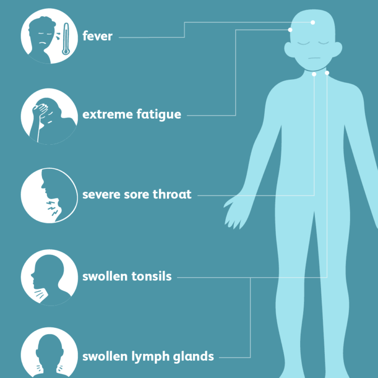 Mononucleosis (MONO) in Young Adults and Teens - Signs and Symptoms ...
